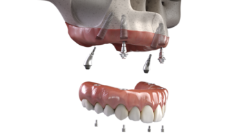 Full Arch Dental Implant Surgical Treatment in Westchester, NY